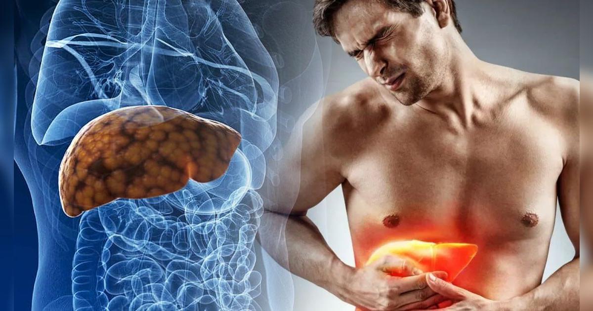 Hígado graso: síntomas clave y cómo prevenirlo a tiempo | Bienhoy