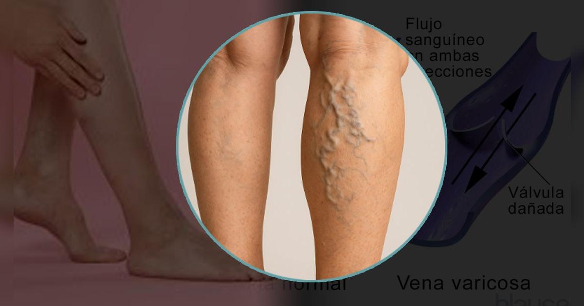 ¿Qué son las várices y cómo prevenirlas? Causas, síntomas y las mejores ...